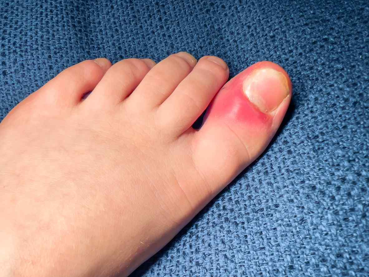 Ingrown Toenail – Cherie Viljoen Podiatry